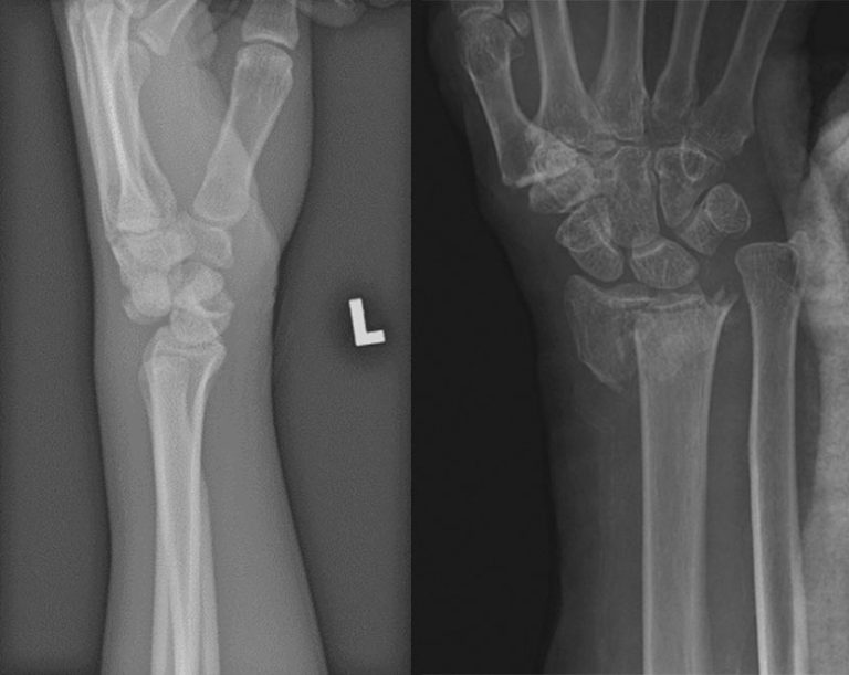 Hand & Wrist Fractures and Traumas - Alpha Joints & Orthopaedics