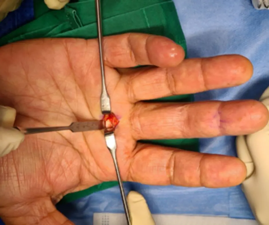 Trigger Finger - Alpha Joints & Orthopaedics